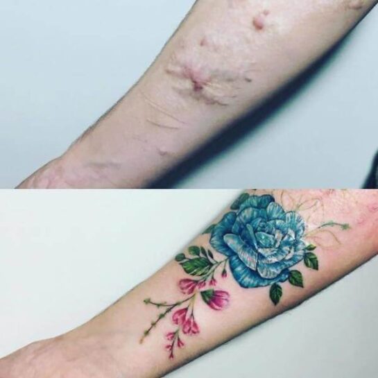 How to Make Scars and Birthmarks into Art