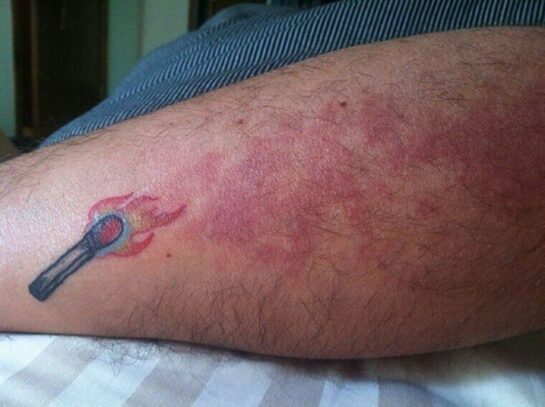 How to Make Scars and Birthmarks into Art